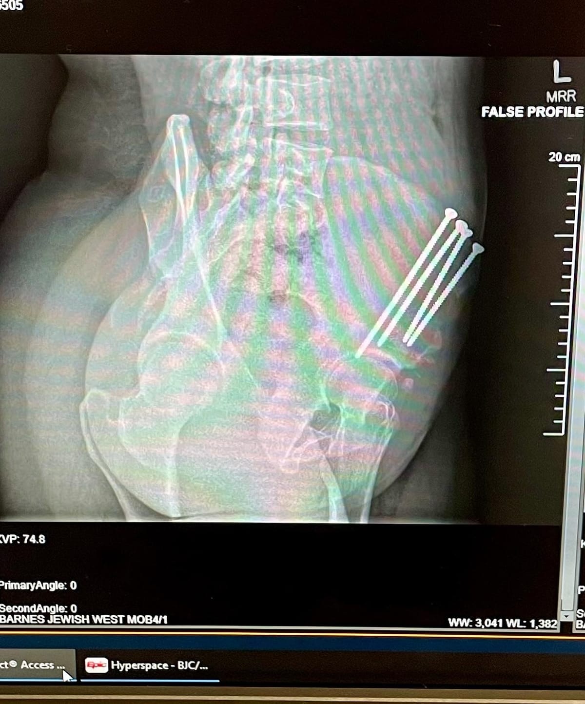 5 Key Facts About Acetabular Retroversion: What You Should Know